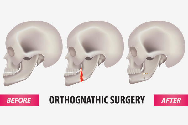 Orthognathic Surgery - Mahogany Oral & Maxillofacial Surgery - Calgary